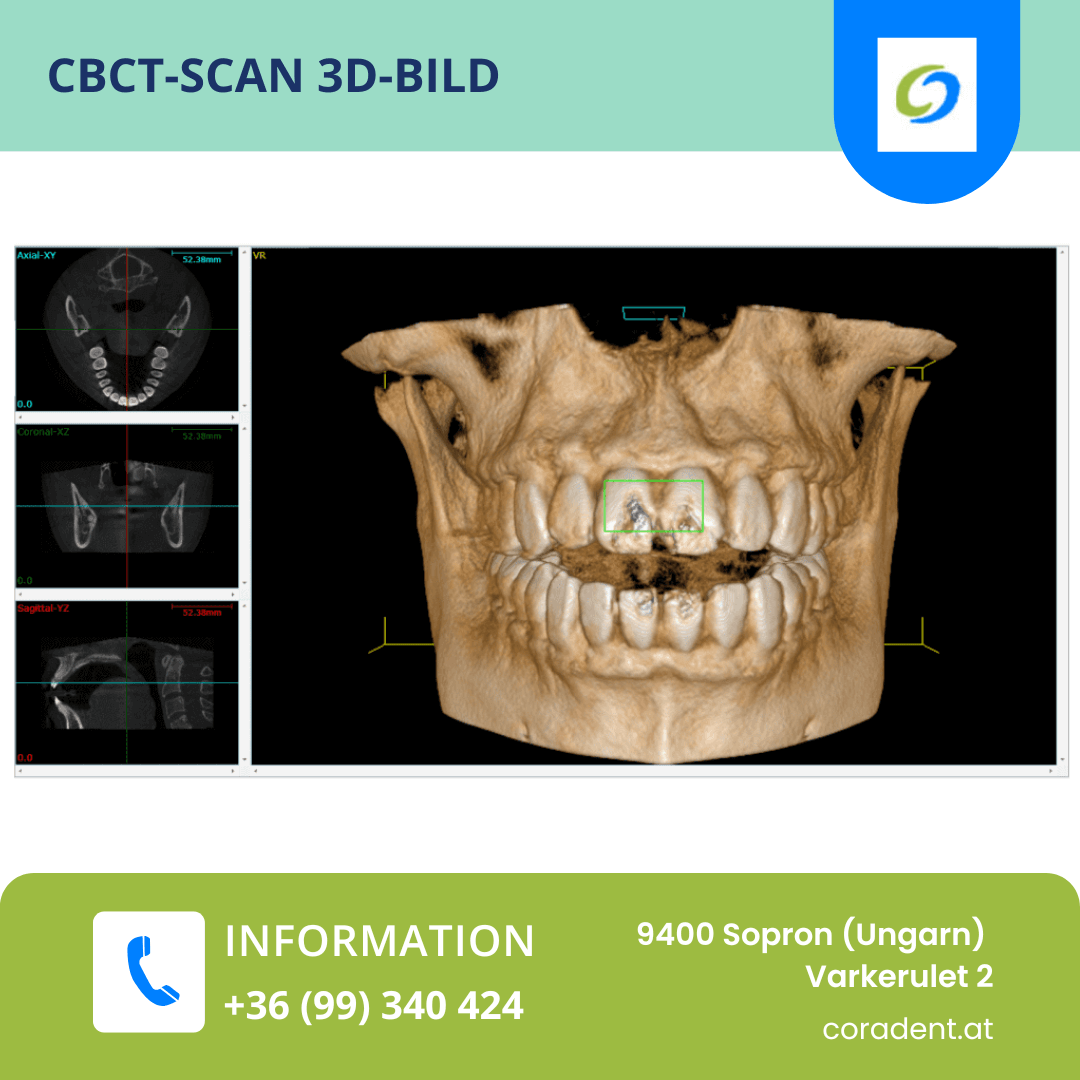 Was ist ein CBCT-Scan und warum wird er benötigt? | Kosten | Coradent