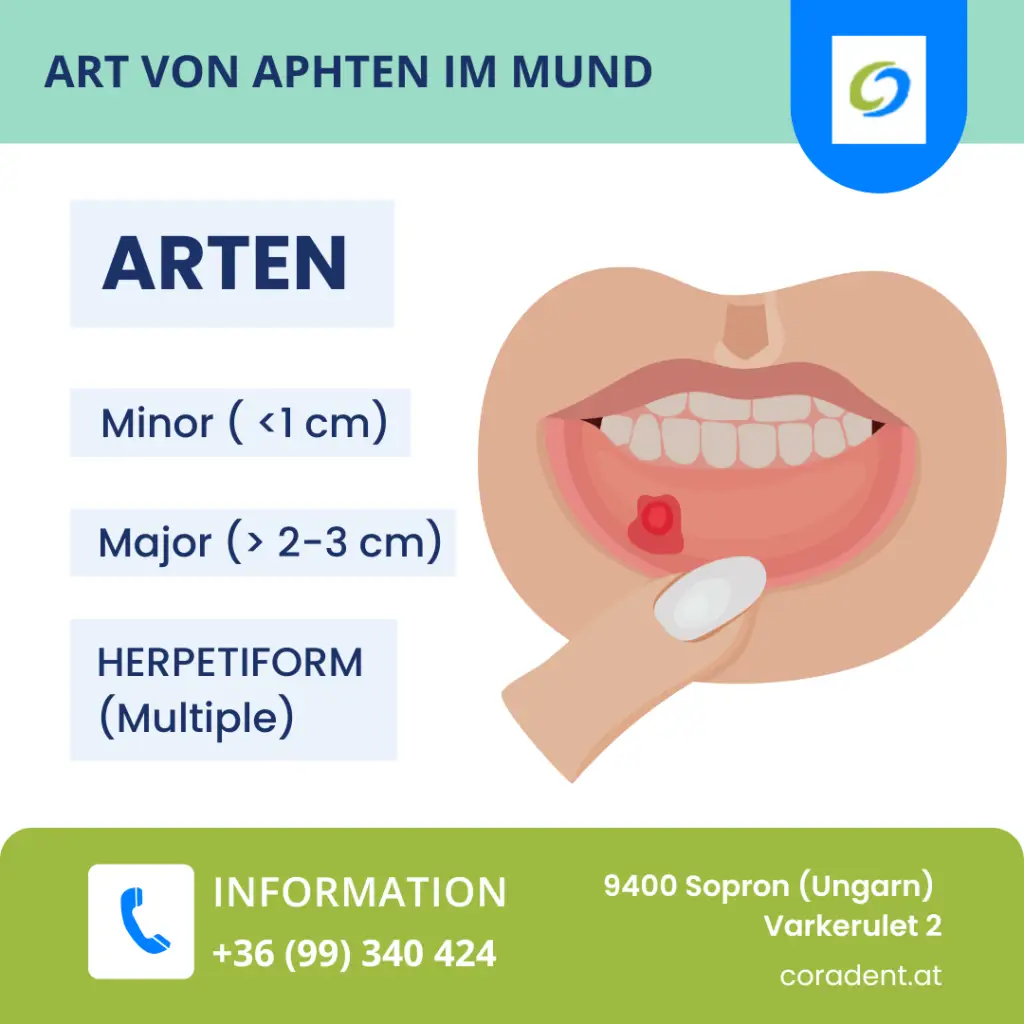 Aphten im Mund: Ursachen, Symptome, Behandlungsmethoden | Coradent ...